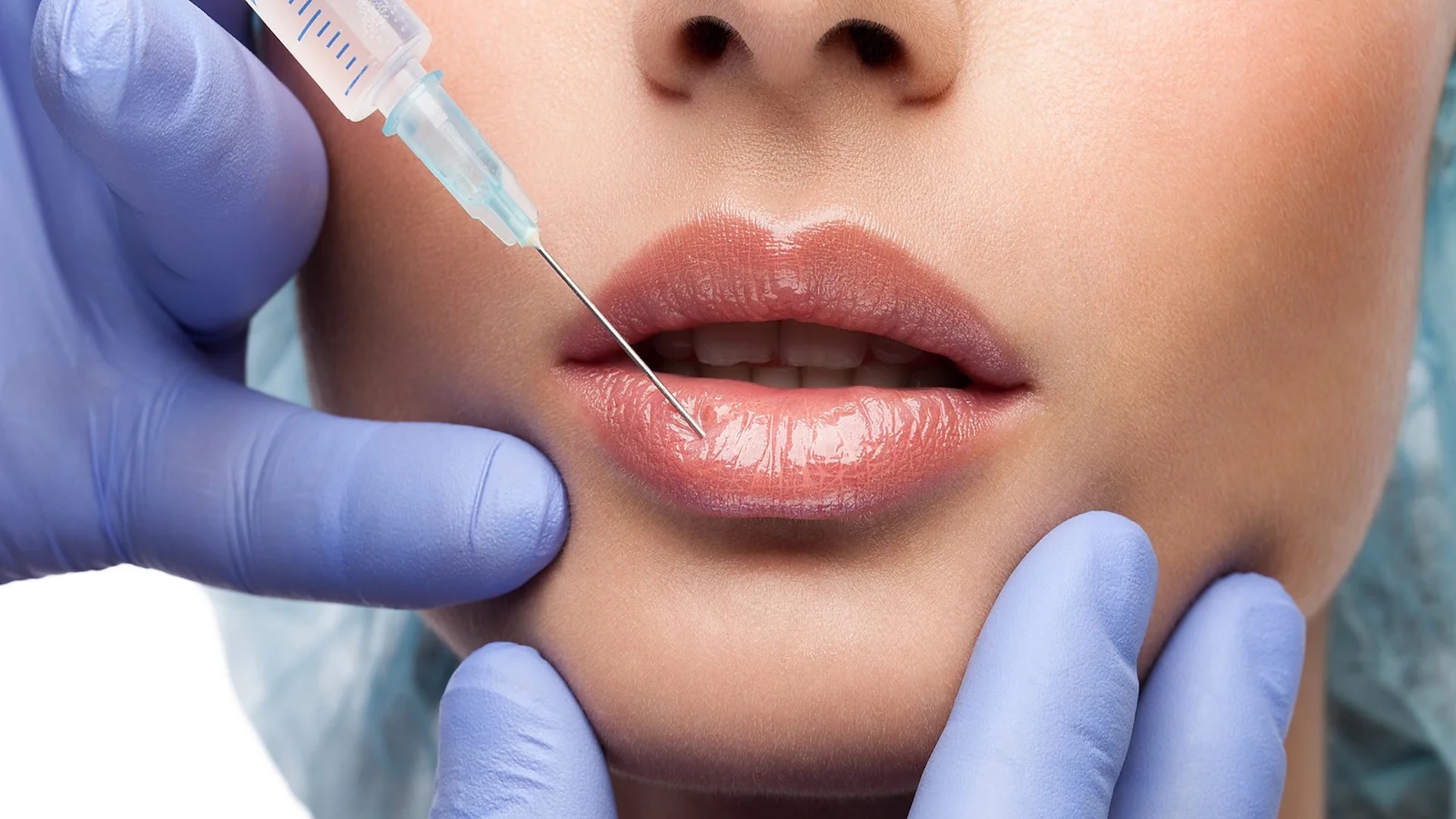 Filler Labbra - Studio Dentistico Ciobanu Milano