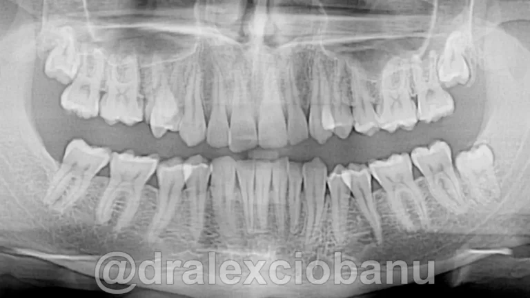 Caso clinico MORSO PROFONDO - Studio Dentistico Ciobanu Milano